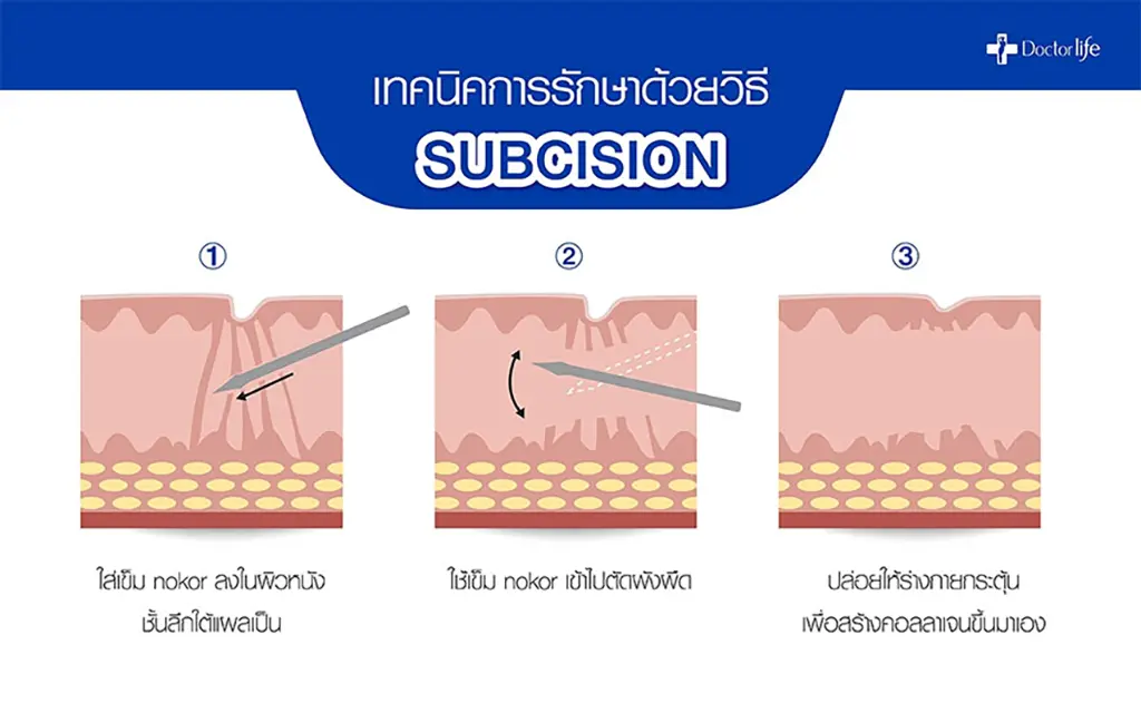 รักษาหลุมสิวให้ผิวหน้าเนียน ด้วยเทคนิคระดับเซียนอย่าง Subcision - Doctorlife Clinic