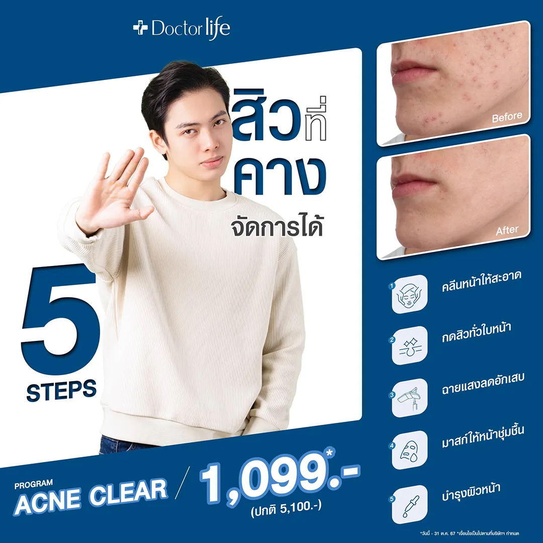 Acne Clear 5 Steps สิวที่คางจัดการได้ - Doctorlife Clinic
